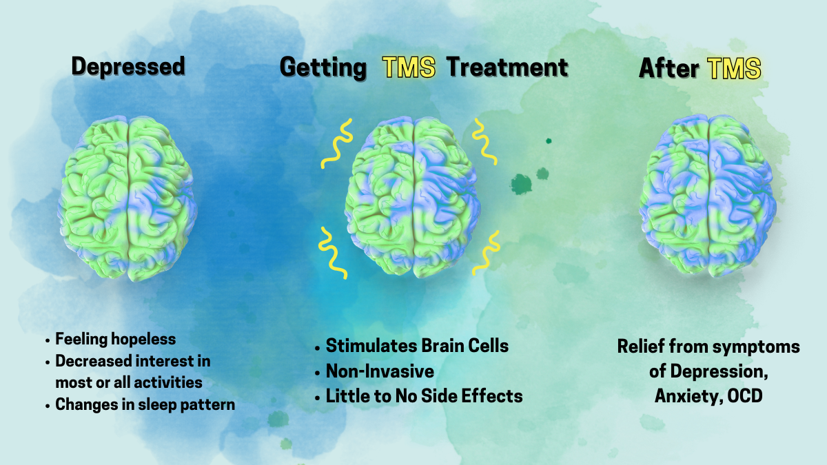 TMS treatment - Dr Albert